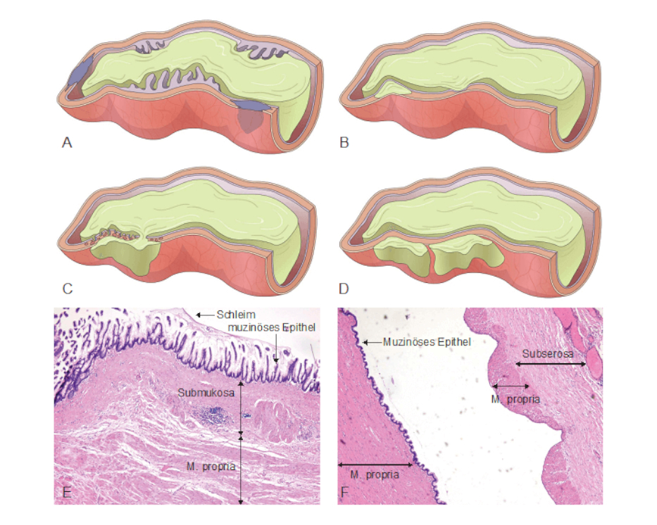 Behandlung und Nachsorge bei low-grade muzinösen Neoplasien der ...